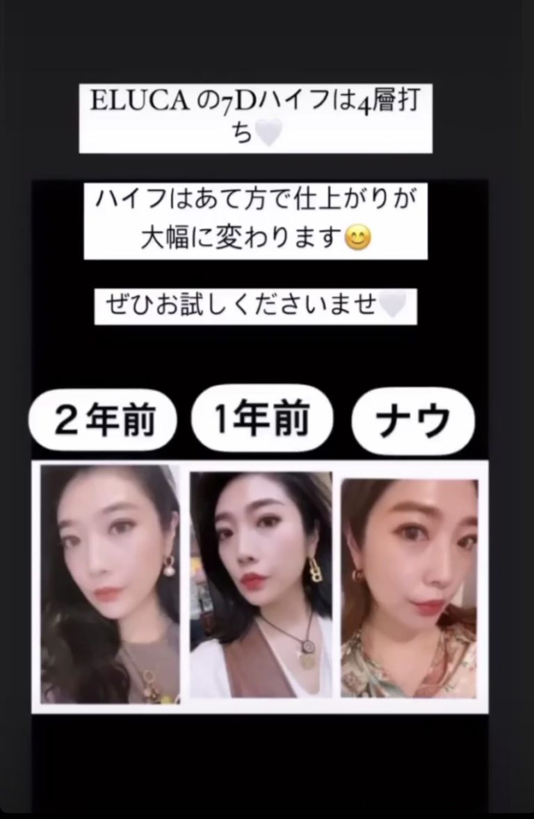 2年間のハイフでのお顔の変化 | 神戸三宮のエステサロンELUCA（エルカ）